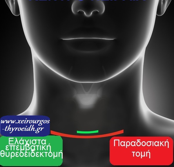 χειρουργική θυρεοειδούς αδένα, thyreoeidectomh, stavros tsirigotakis